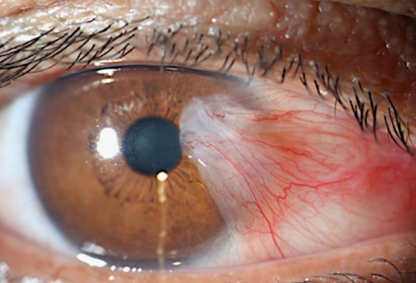 Carnosidades - Vida Saludable